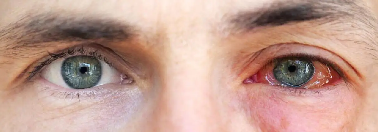 24x7 Emergency Eye Hospital in Delhi for Eye Trauma Treatment